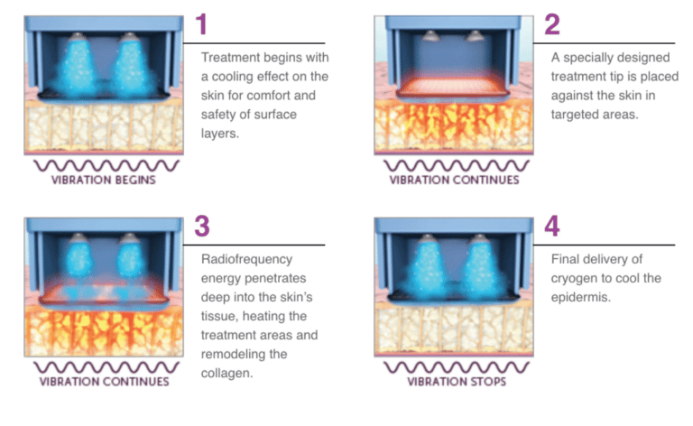 Thermage - Greenwich Dermatology