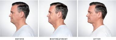 Fat Reduction For Men - Greenwich Dermatology