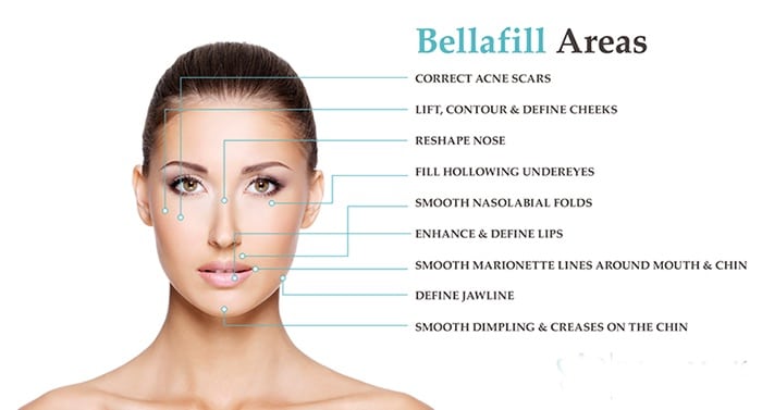 Bellafill - Greenwich Dermatology