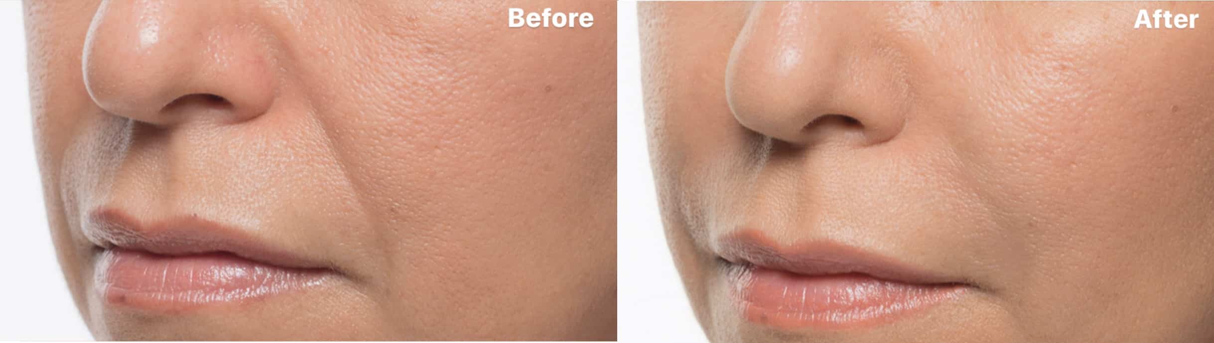 Bellafill - Greenwich Dermatology