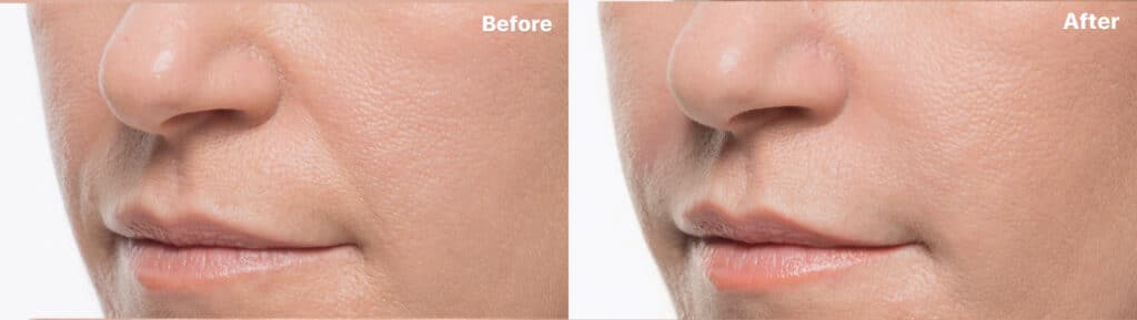 Bellafill - Greenwich Dermatology